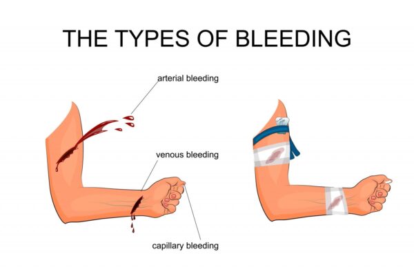 Do you know the 3 different types of bleeding and how to control them?